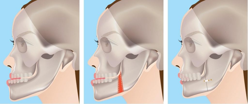 Jaw Correction Surgery: What Does It Do? - CLINICLO