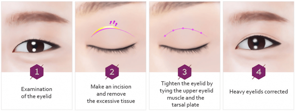 Ptosis Correction in Korea: Quick Facts Before Getting Ptosis Surgery ...